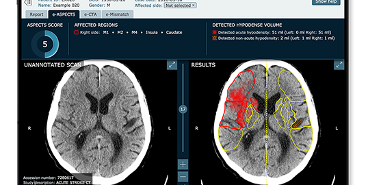 Automated ASPECTS significantly impacted by reconstruction kernel and slice thickness | News