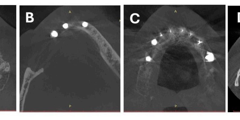 Reducing noise and metal artifacts in oral CBCT using AI | News