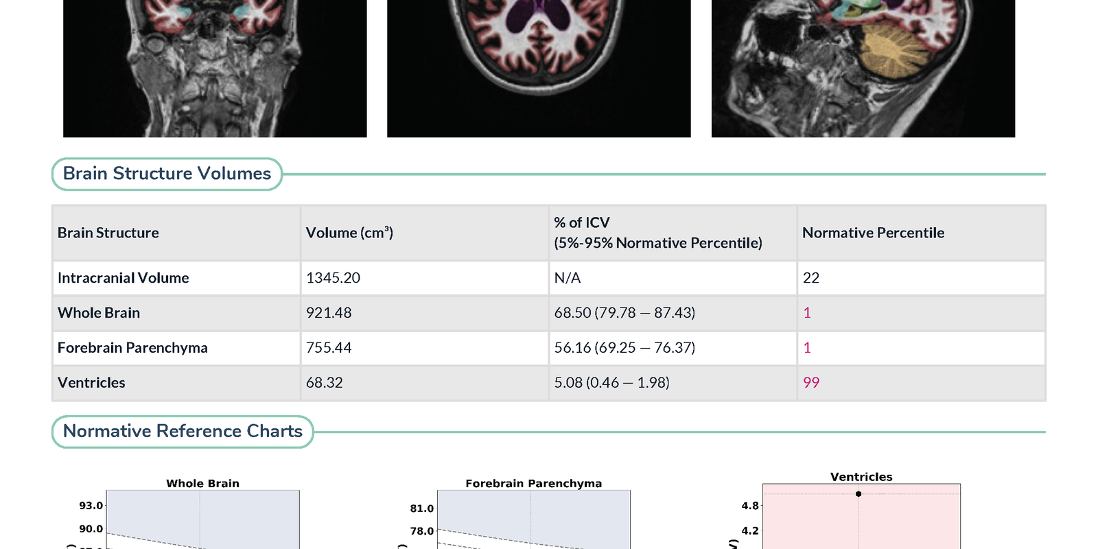 Reliability and bias in brain volumetry: comparison of three software ...