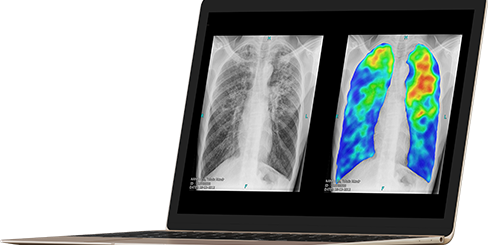 AI-based chest x-ray analysis nearly meets WHO criteria for ...