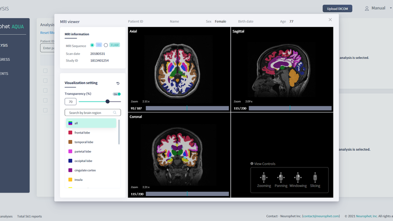 Deep learning segmentation offers reliable Alzheimer's disease subtype ...