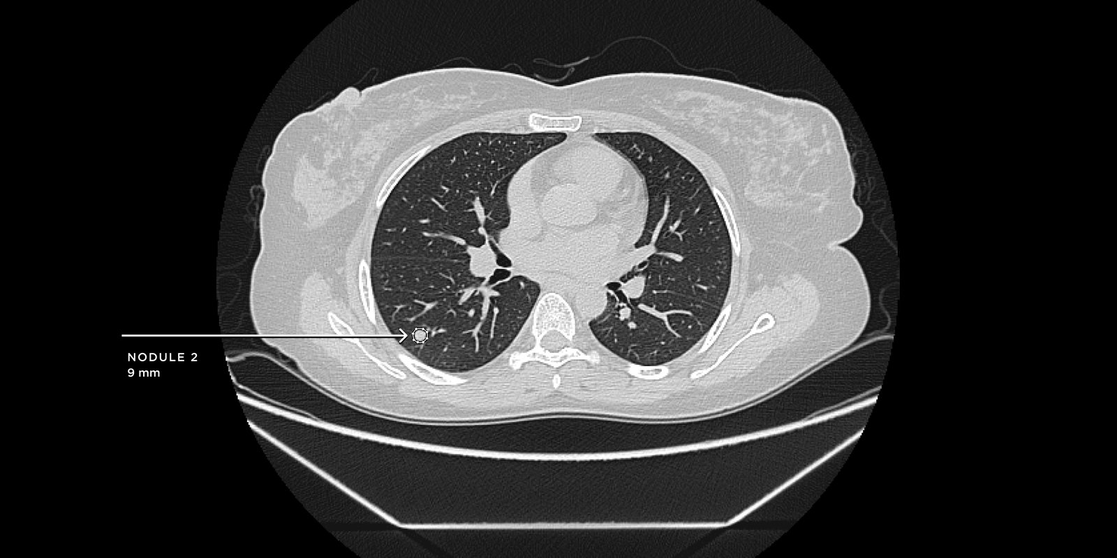 Validation Of A Cad System For Lung Nodule Analysis Reliable Detection