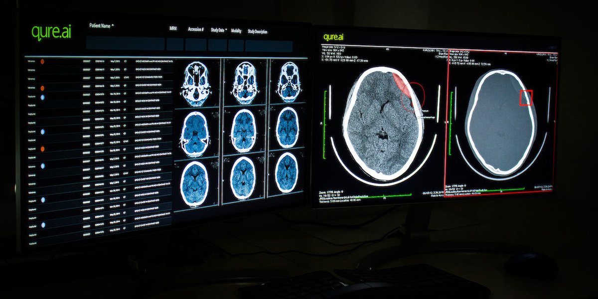 AI achieves high accuracy in intracranial hemorrhage detection, but ... AI achieves high accuracy in intracranial hemorrhage detection, but ...