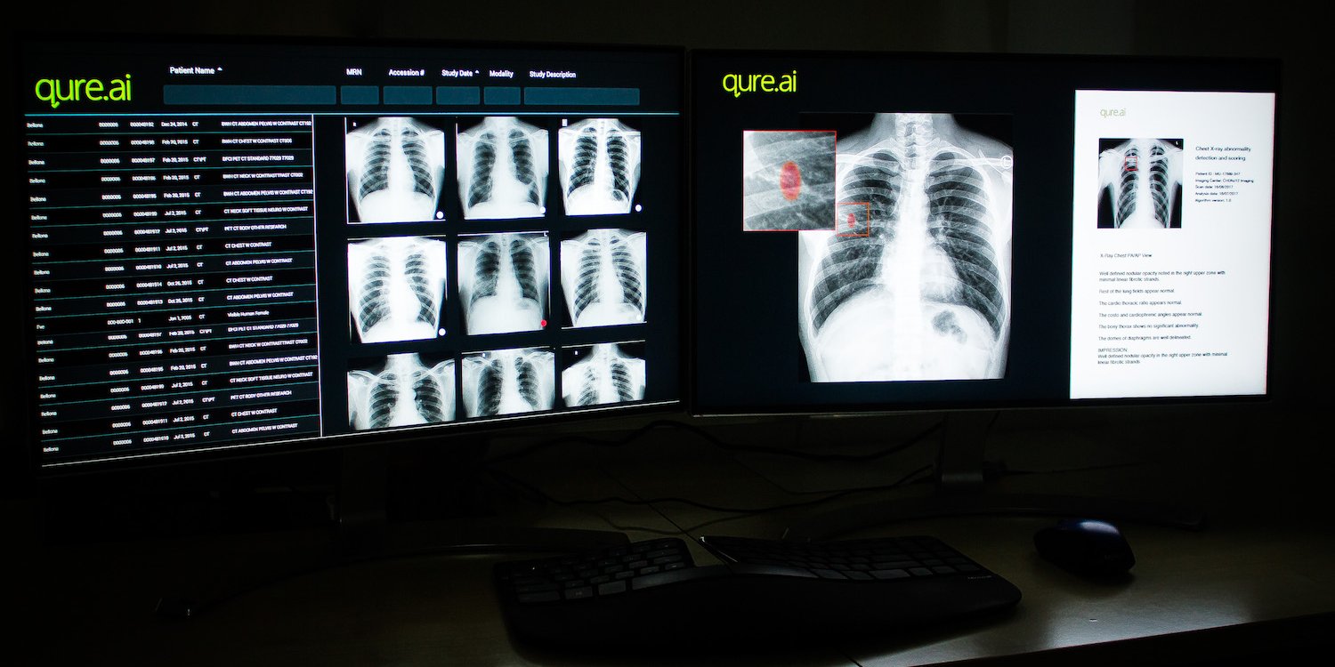 Evaluating AI in a low TB-prevalence setting: potential for enhanced ...