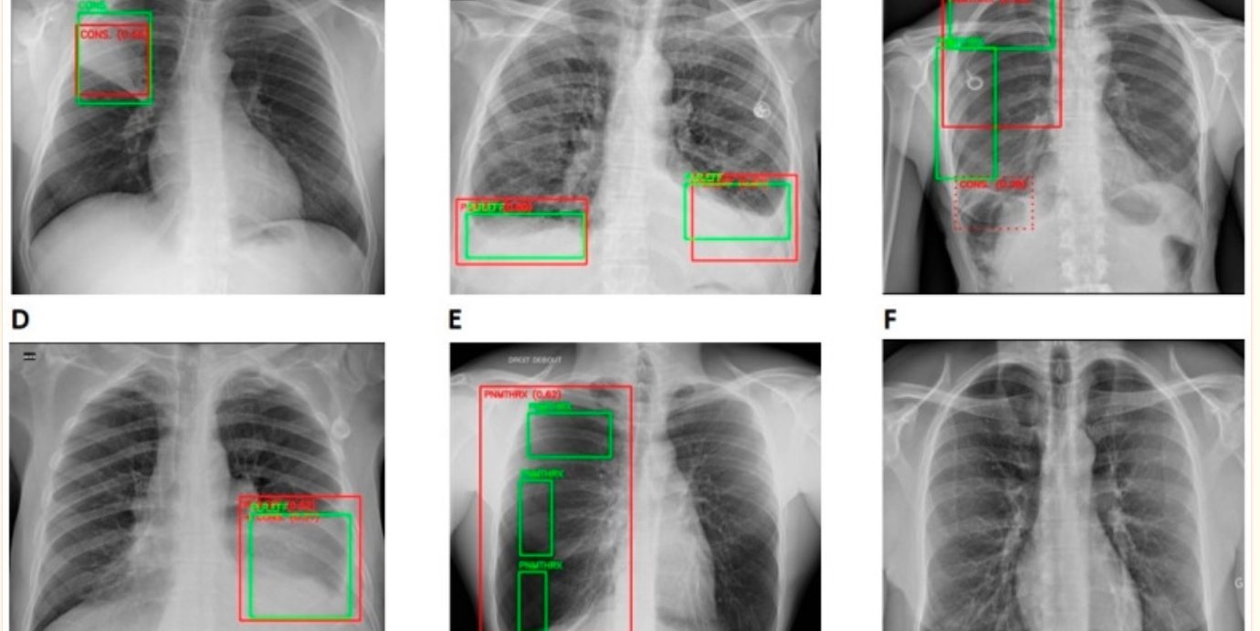 AI in chest X-rays: enhanced accuracy and decreased reading time for ...