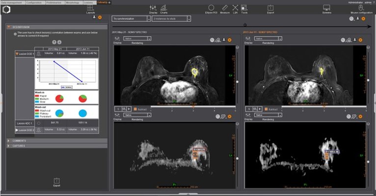 breastscape® v1.0 - Olea Medical