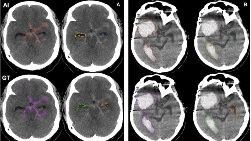 Reliable quantification of midline shift and volume changes in ...